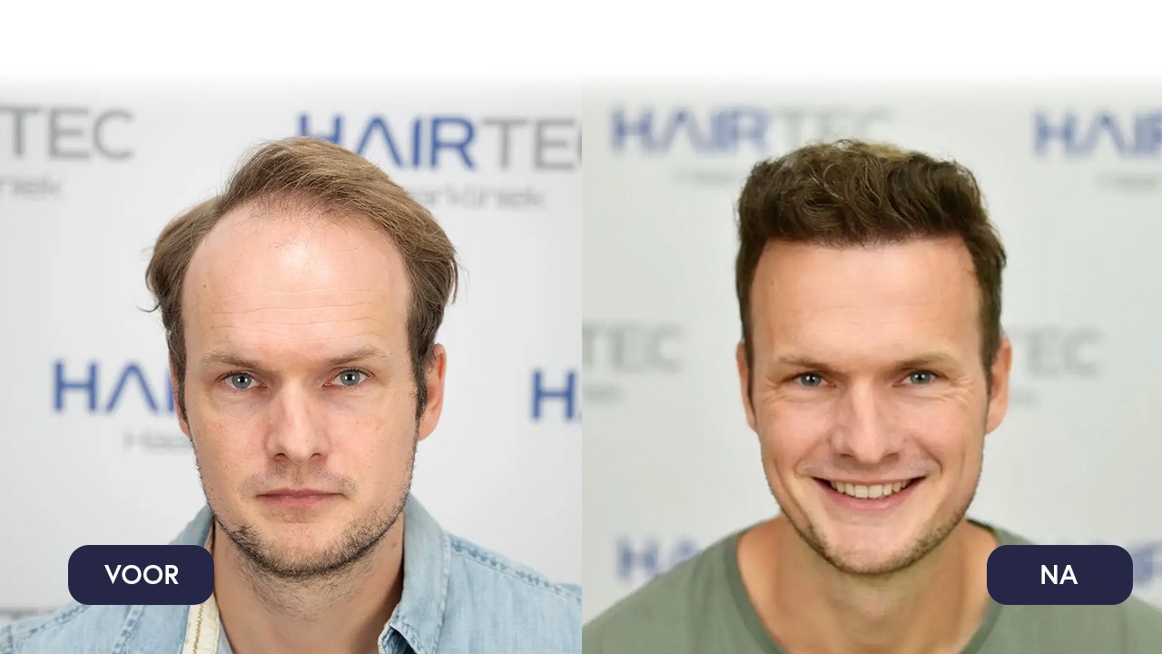 Haartransplantatie: deze foto’s laten zien dat je écht niet naar ...